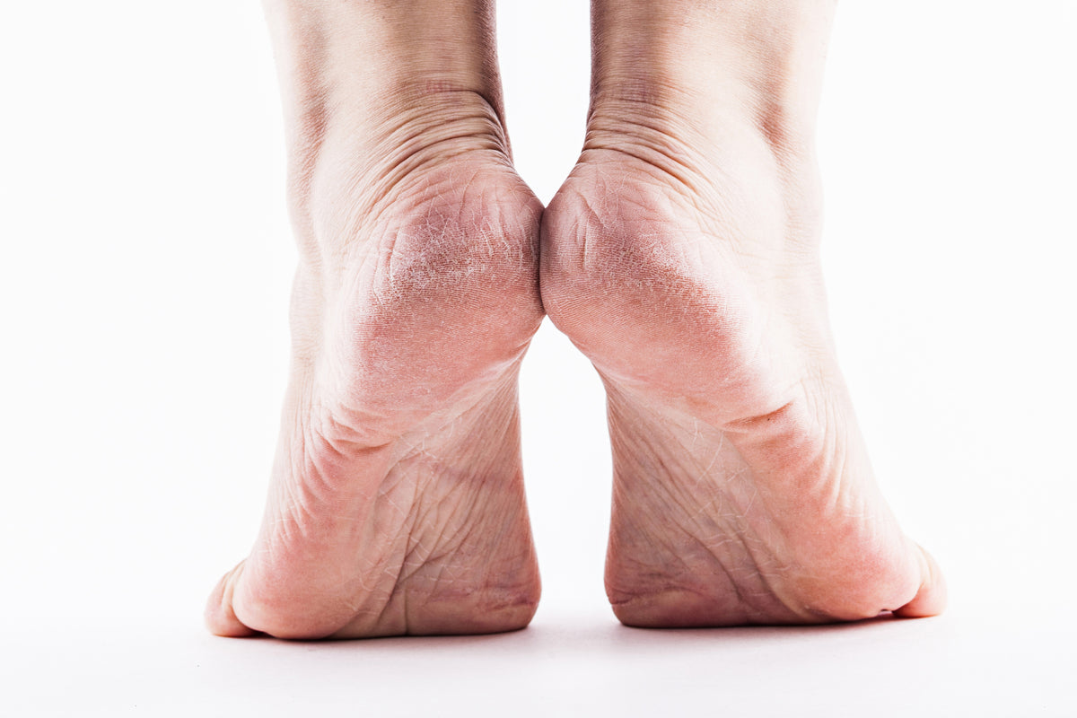 Dry Skin or Athlete's Foot? How to spot the difference. – Pedicurian